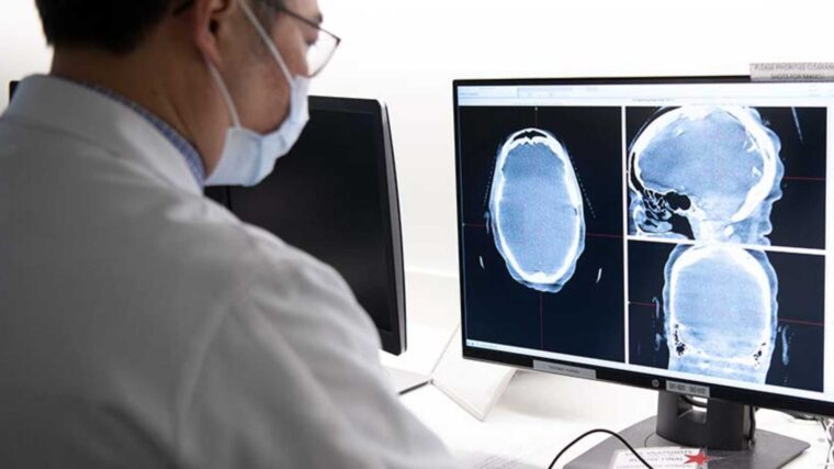 Meningioma: el tumor cerebral más frecuente en adultos